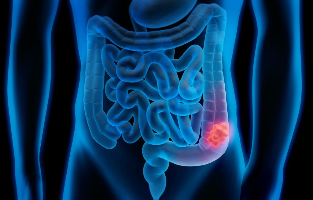 Bowel Cancer Awareness Month: Are You Bowel Cancer Aware?